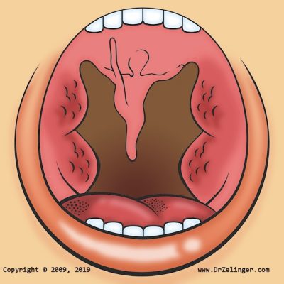 Please Explain Tonsillectomy and Adenoidectomy to Me – Dr. Laurie ...